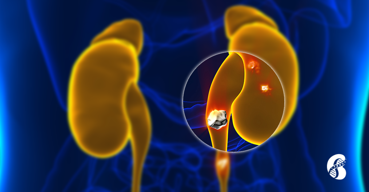 Kidney Stones: The Integrative Approach to Prevention and Management